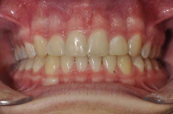 Before and After Orthodontic Results | Figueroa Orthodontics