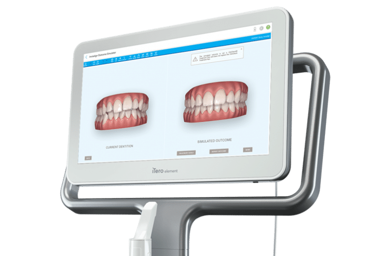 iTero Digital Impressions Naperville Winnetka IL | Figueroa Orthodontics
